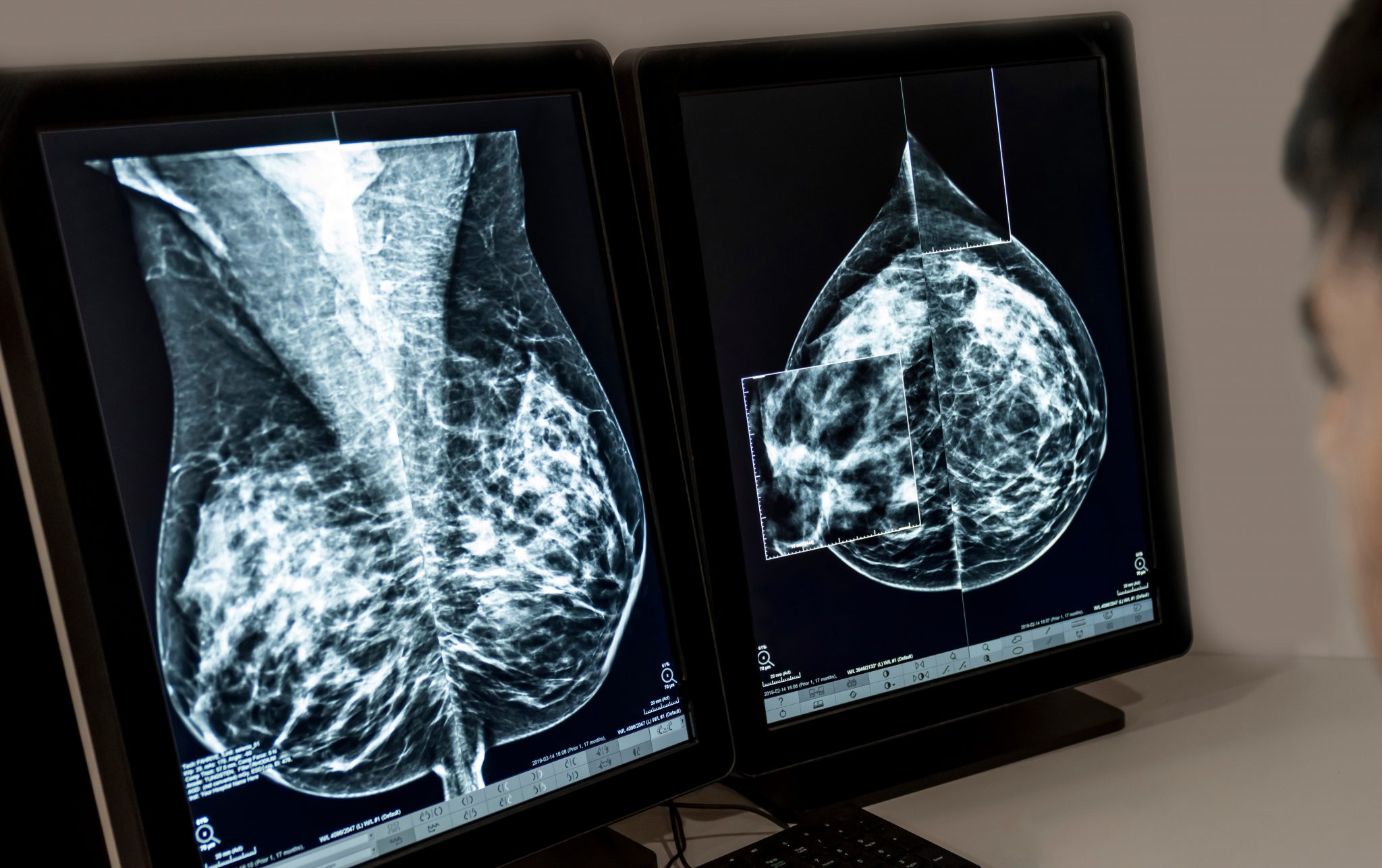 Women pay for AI to boost mammogram findings